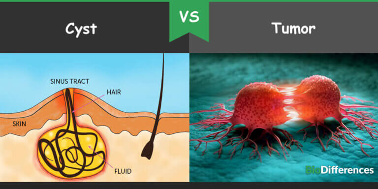 Difference Between Cyst and Tumor – Bio Differences